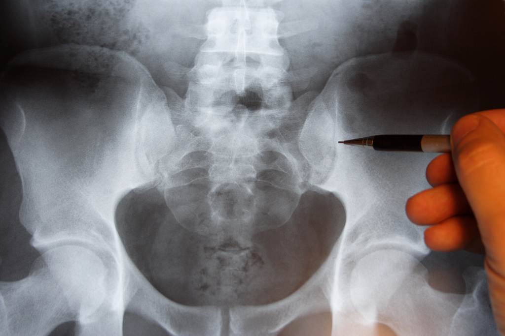 Agenesia Sacrale Radiografia A) Isolated Sacral Agenesis (Renshaw Type