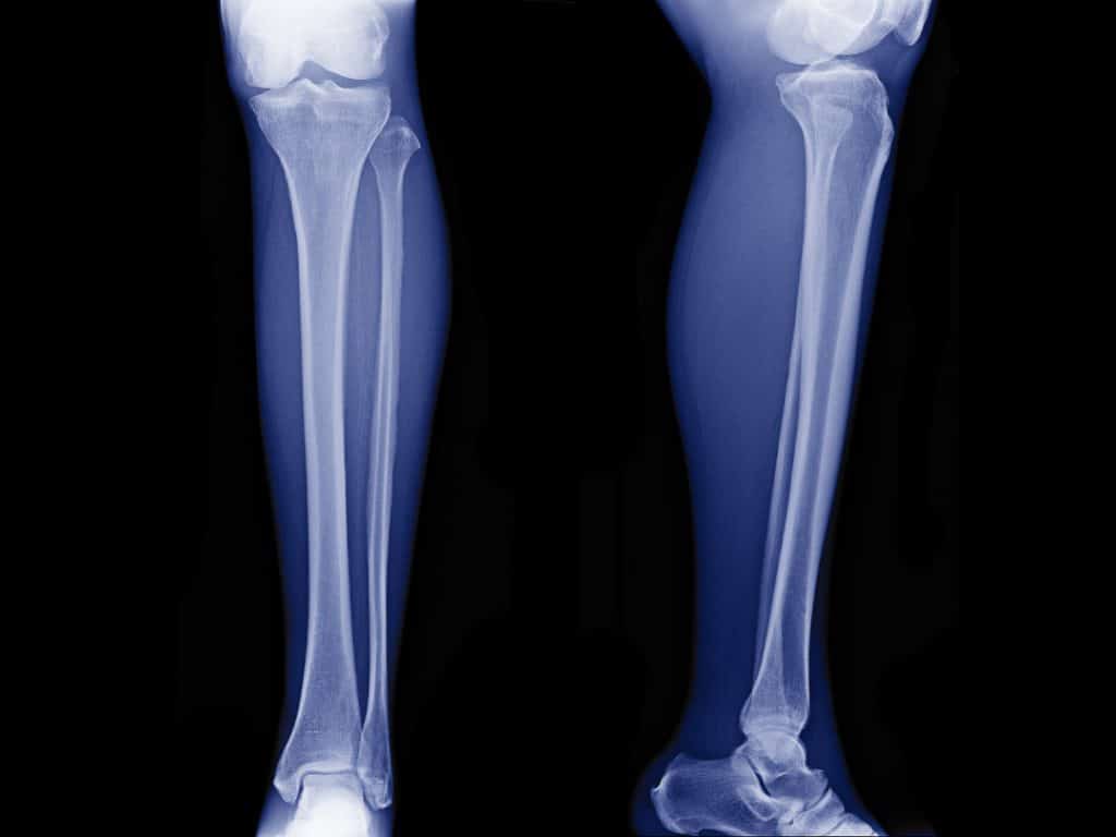 RX gamba: l'esame radiologico di tibia e perone